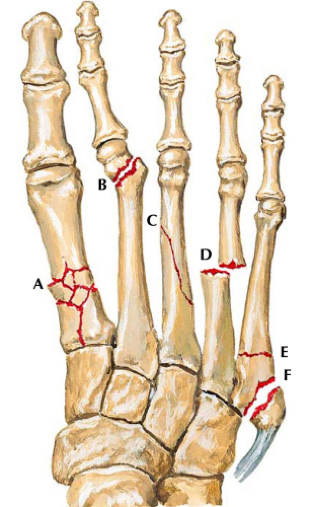 Clínica e Cirurgia do Pé e Tornozelo: Fraturas dos Metatarsos