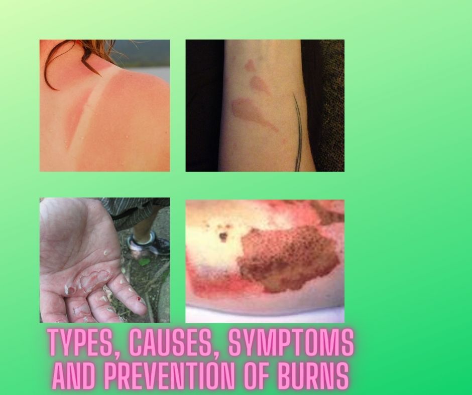 10+ Home remedies for Burns with its cause and symptoms