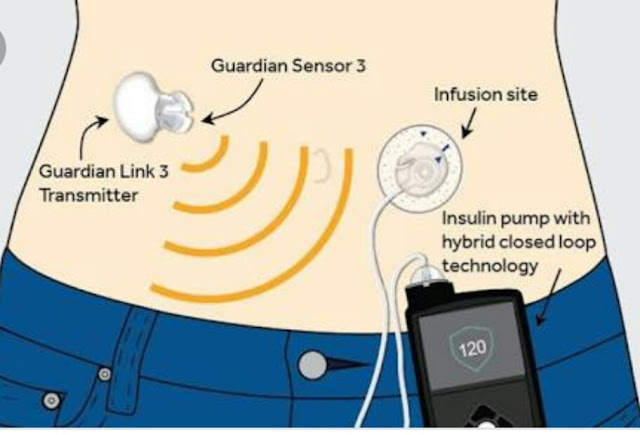 Artificial pancreas raises hope for Type1 diabetes patients - HEALTHY ...