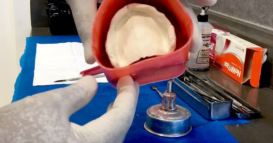 PRÓTESE TOTAL: Preparo do molde funcional para construção do modelo de ...