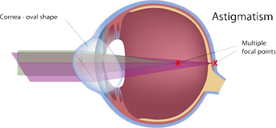 The Astigmatic Eye | Refraction in Astigmatism