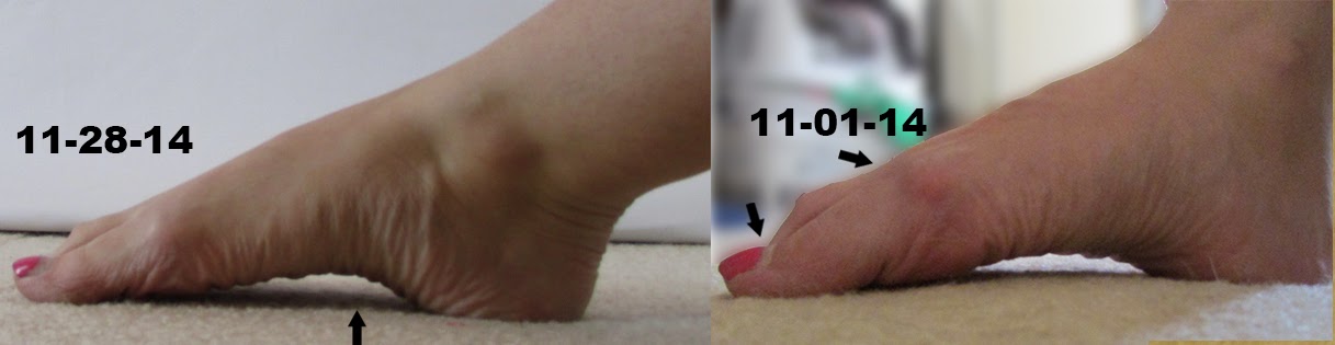 The Late Ballerina: Foot Arch/Doming Improvement