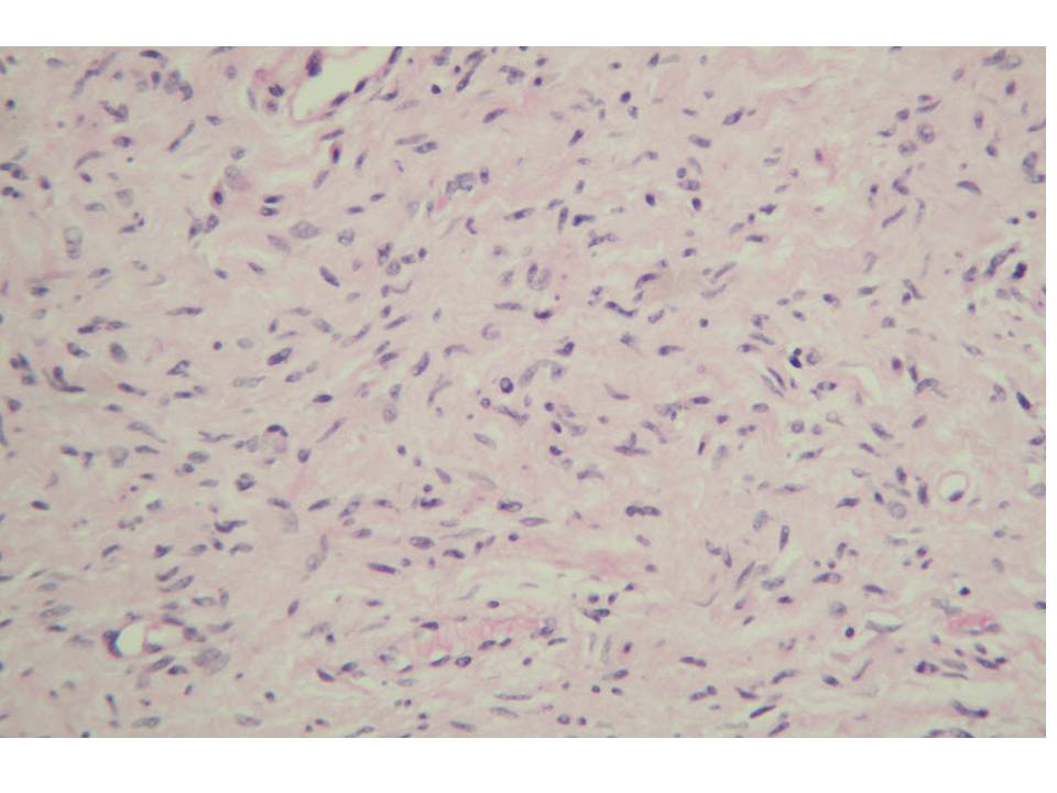 Consultations in Dermatology: Multiple Pink Nodules - Neurofibromatosis
