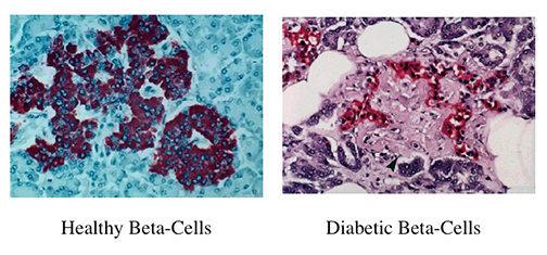 HEALTH FROM TRUSTED SOURCES: Diabetes type 2