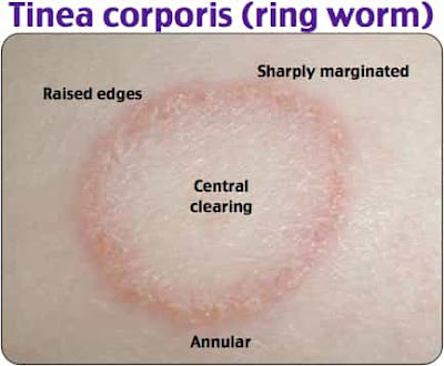 Ringworm of the Scalp (Tinea Capitis) - Online Study