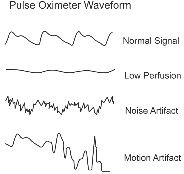 Manuali di Medicina Intensiva: Pulsossimetria (Capitolo 3.3.1)