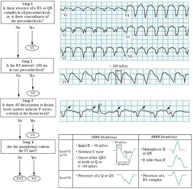 Wide Complex Tachycardia Case File