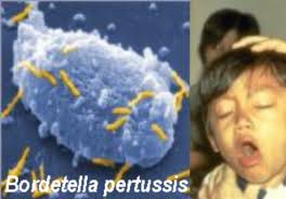 UN VISTAZO A INFECCIÓN POR BORDETELLA PERTUSIS.