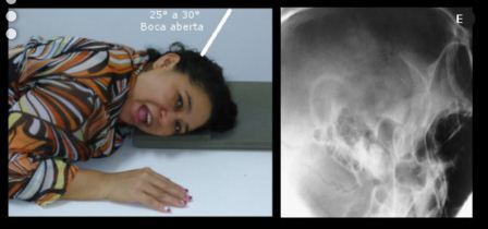 Ossos da Face- ATM Axiolateral - Boca Aberta