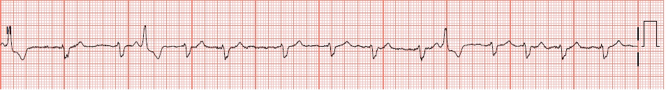 Float Nurse: EKG Rhythm Strips 56: Atrial Fibrillation