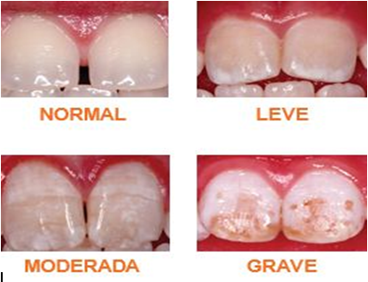 Consultório OdontoloJosy: Fluorose Dentária