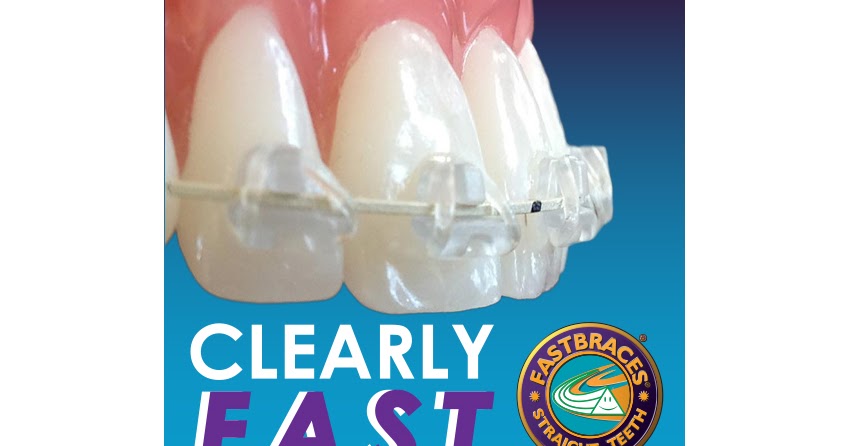 ortodonti: Hızlı Diş Teli - Fastbraces