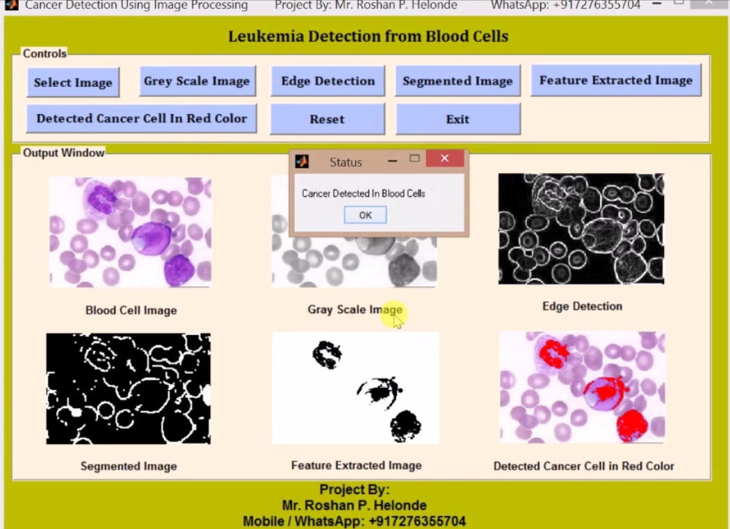 Leukemia Detection from Blood Cells using Image Processing Matlab ...