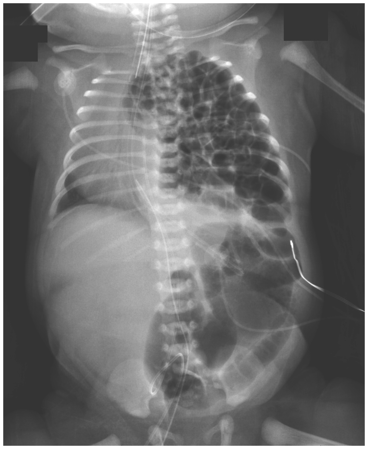 Rheobase Medical: Congenital Diaphragmatic Hernia (Bochdalek Hernia)