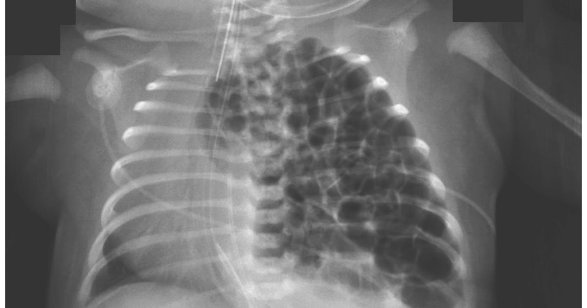 Rheobase Medical: Congenital Diaphragmatic Hernia (Bochdalek Hernia)