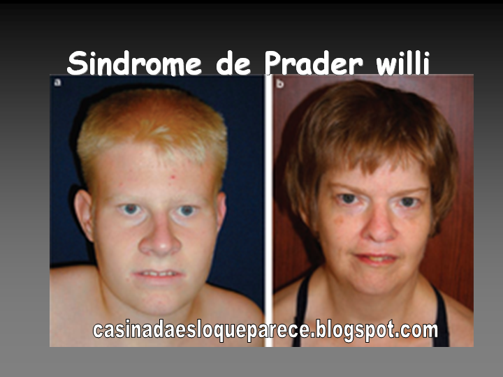 El síndrome de Prader-Willi (SPW)