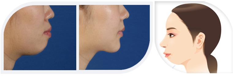 Eyelid Surgery Legend Dr. Kim Byung Gun: [BK Plastic Surgery Hospital ...