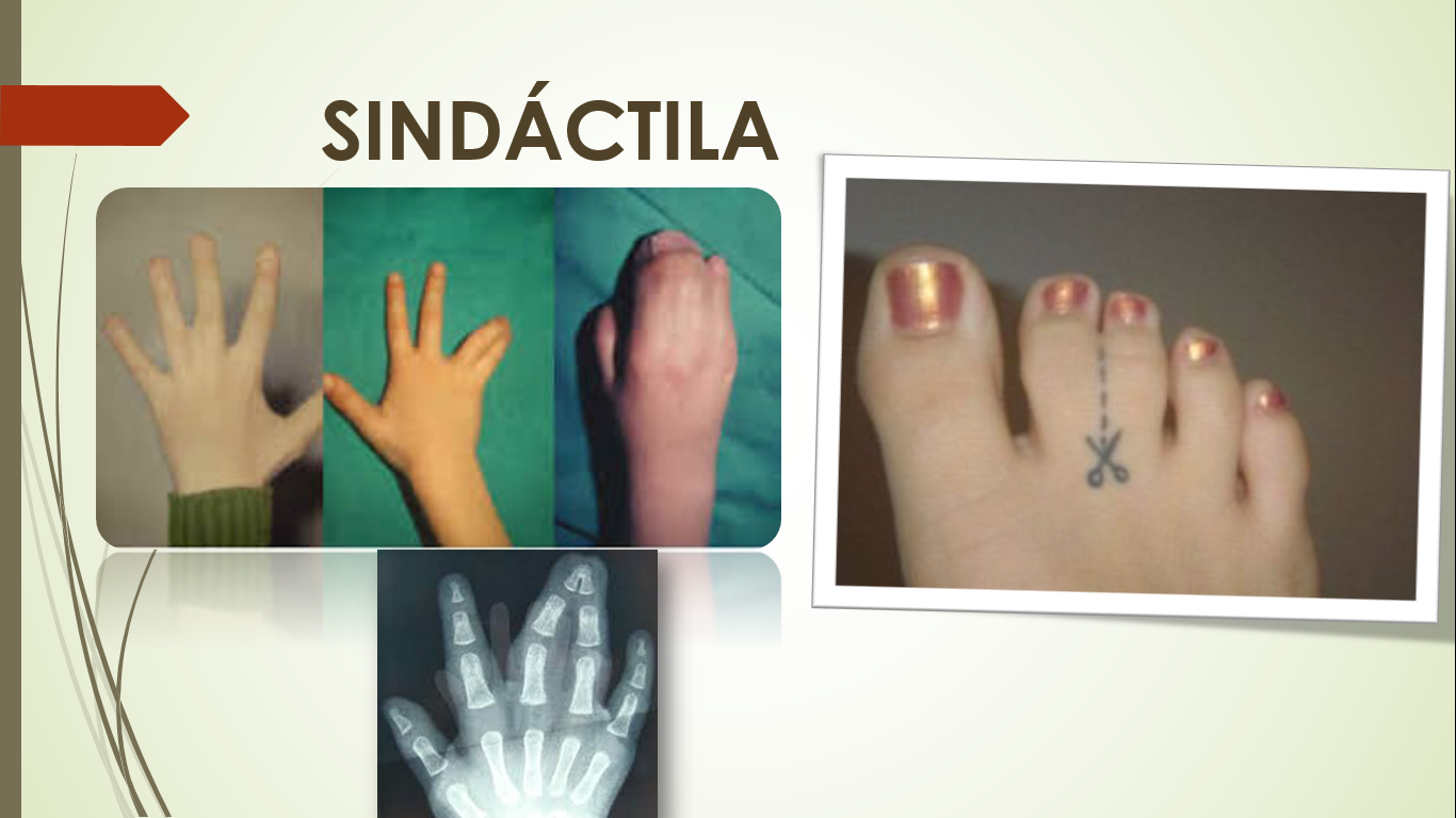 Somos diferentes, somos Terapia Ocupacional: SINDÁCTILIA