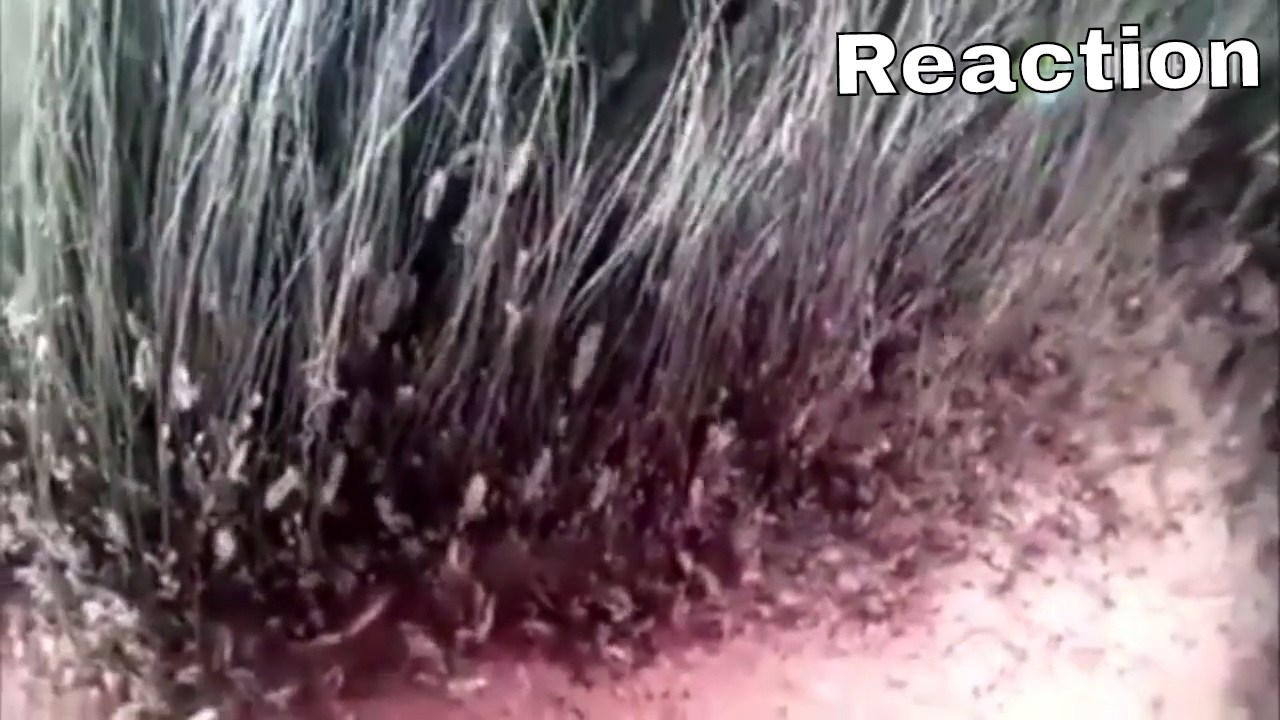 Head lice infestation