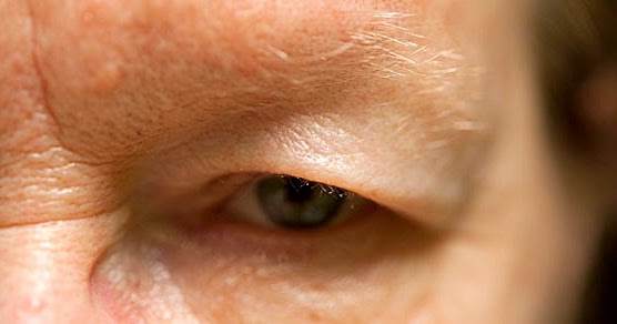 Dermatochalasis Images, Definition, Symptoms, Causes, Surgery - Health ...