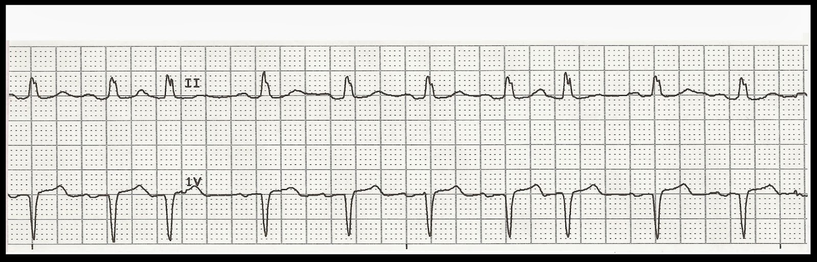 Practice EKG Rhythm Strips 212