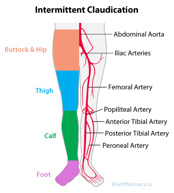 ~ ACCOUNTING 2 COOKING ~: Sakit belakang peha ~ Intermittent Claudication?