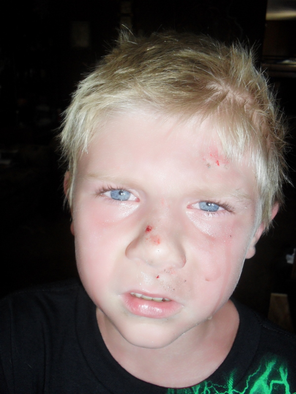 Road Rash.......and The Prickly Pear