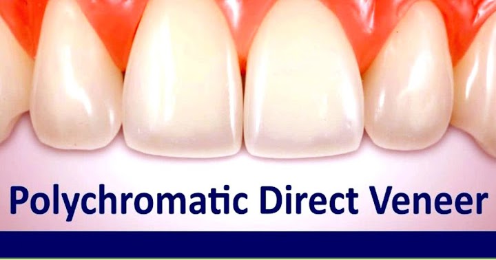 OPERATIVE DENTISTRY: Polychromatic Direct Veneer with Dr. Newton Fahl ...