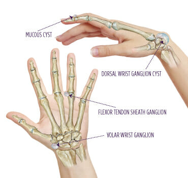 Ganglion Cysts : Symptoms, Causes, and Treatment