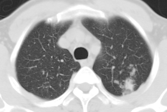 Intramedullary Spinal Cord Tuberculoma-MRI - Sumer's Radiology Blog