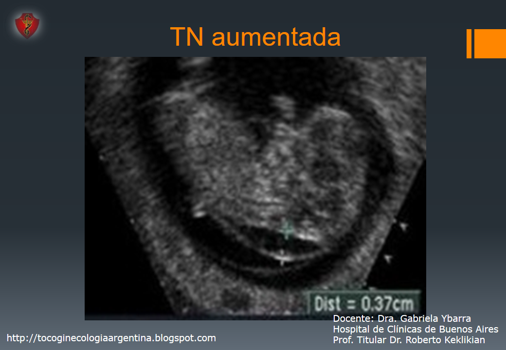 TOCOGINECOLOGIA ARGENTINA: Caso Amalia. Respuesta: Translucencia nucal ...
