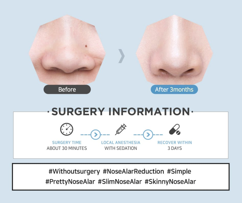 Plastic Surgery in Korea : Complex Nose Alar Reduction
