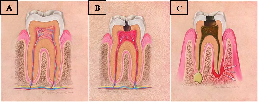 Infeksi Odontogen | Health Care