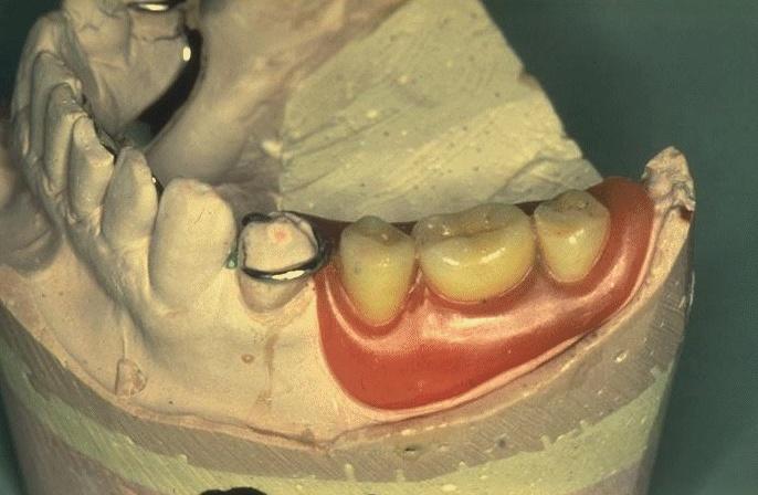 Dentistry lectures for MFDS/MJDF/NBDE/ORE: A Note On Clinical steps for ...