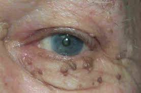 Photos of Skin Tags on Eyelids ~ How To Remove Moles, Warts, Skin Tags ...