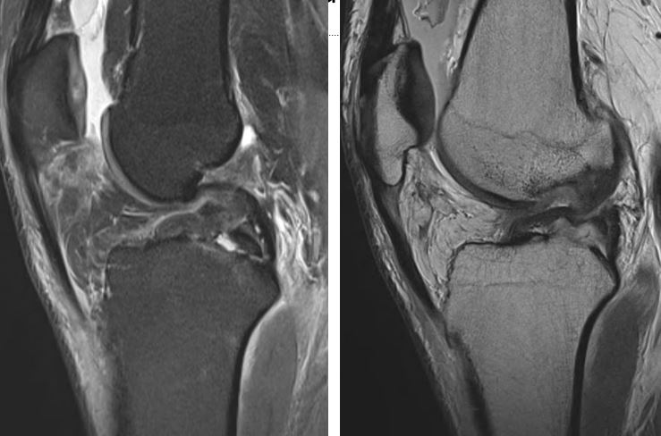 Joint Preservation and Replacement : Should'nt root lesions be a part ...