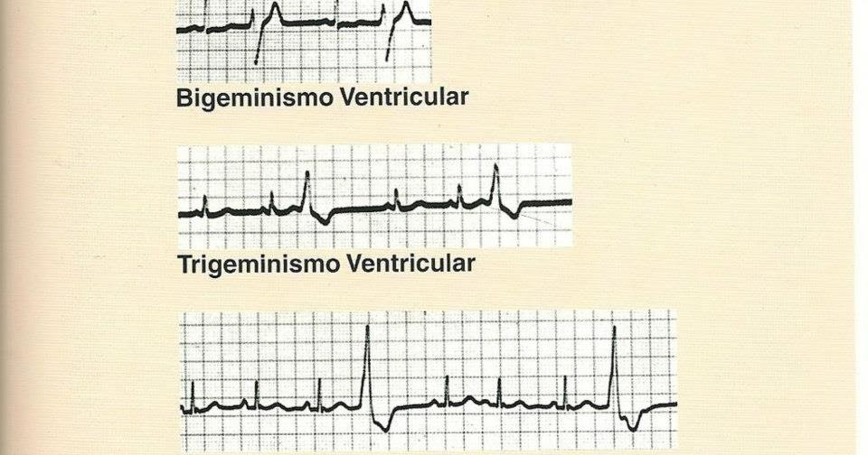Electrocardiograma y Medicina General: ¿Qué es el bigeminismo?