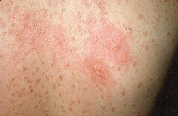 Gejala Penyebab Alergi Pada Tubuh | Tips Sehat Alami