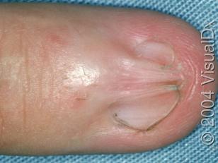 The Naily Guide To Flaws And Fungus: Pterygium