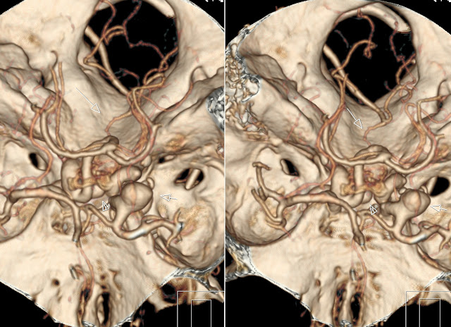 Aneurysm of Persistent Trigeminal Artery