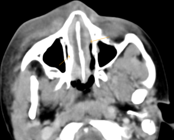 Nasal Septal Abscess-CT - Sumer's Radiology Blog