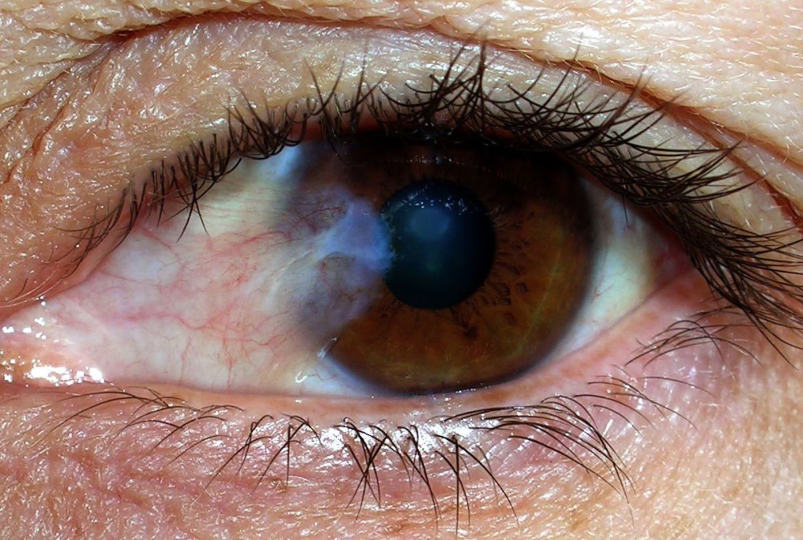 Radiación UV, polvo y sequedad también generan carnosidad en los ojos ...