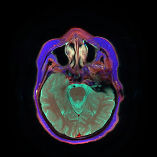 Nevit's blog: Color MRI - Lymphoma of the Neck