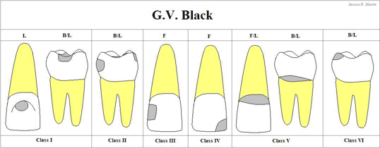 Dr.Hani Meri DDS: Black's Classification of Caries Lesions