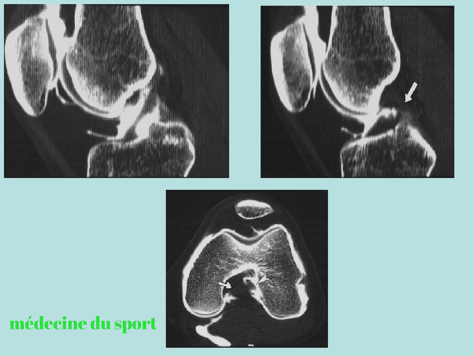 IMAGERIE DU GENOU APPLIQUÉE A LA PATHOLOGIE SPORTIVE