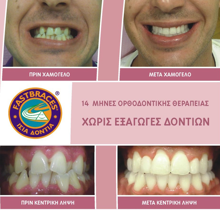 The Sekouratoi: ΟΡΘΟΔΟΝΤΙΚΗ (ΙΣΙΑ ΔΟΝΤΙΑ) ΣΕ ΛΙΓΟΤΕΡΟ ΧΡΟΝΟ ΚΑΙ ΧΩΡΙΣ ...
