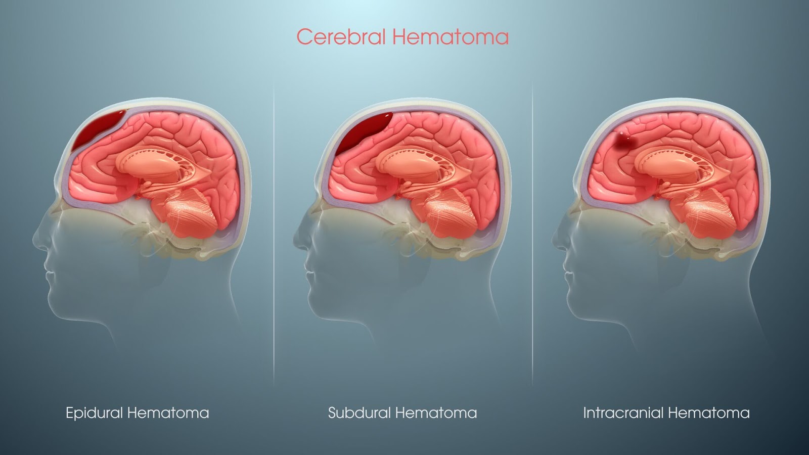 Diagnóstico de la Hemorragia Intracraneal
