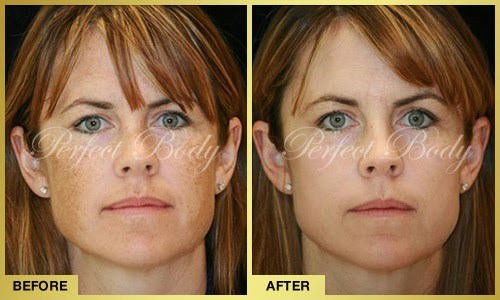 Perfect Body Laser and Aesthetics: IPL/ Photofacial