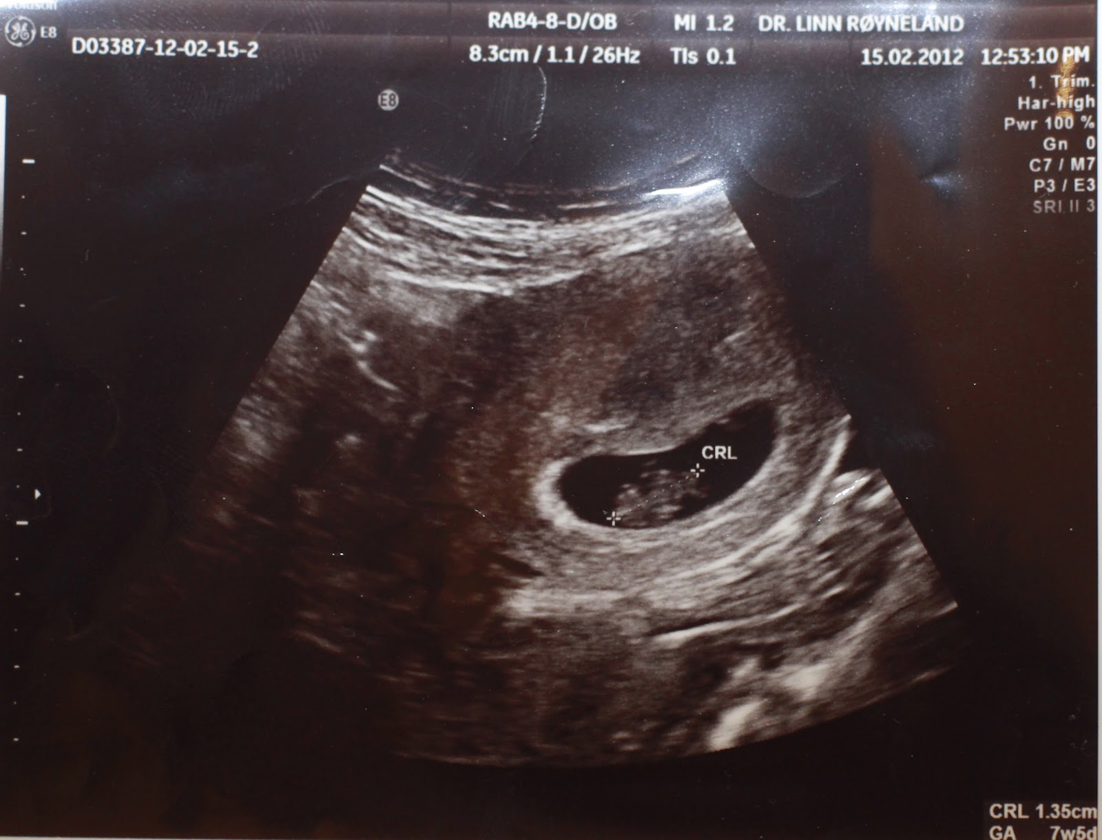 Gravid mor: Ultralyd uke 8 hva ser man