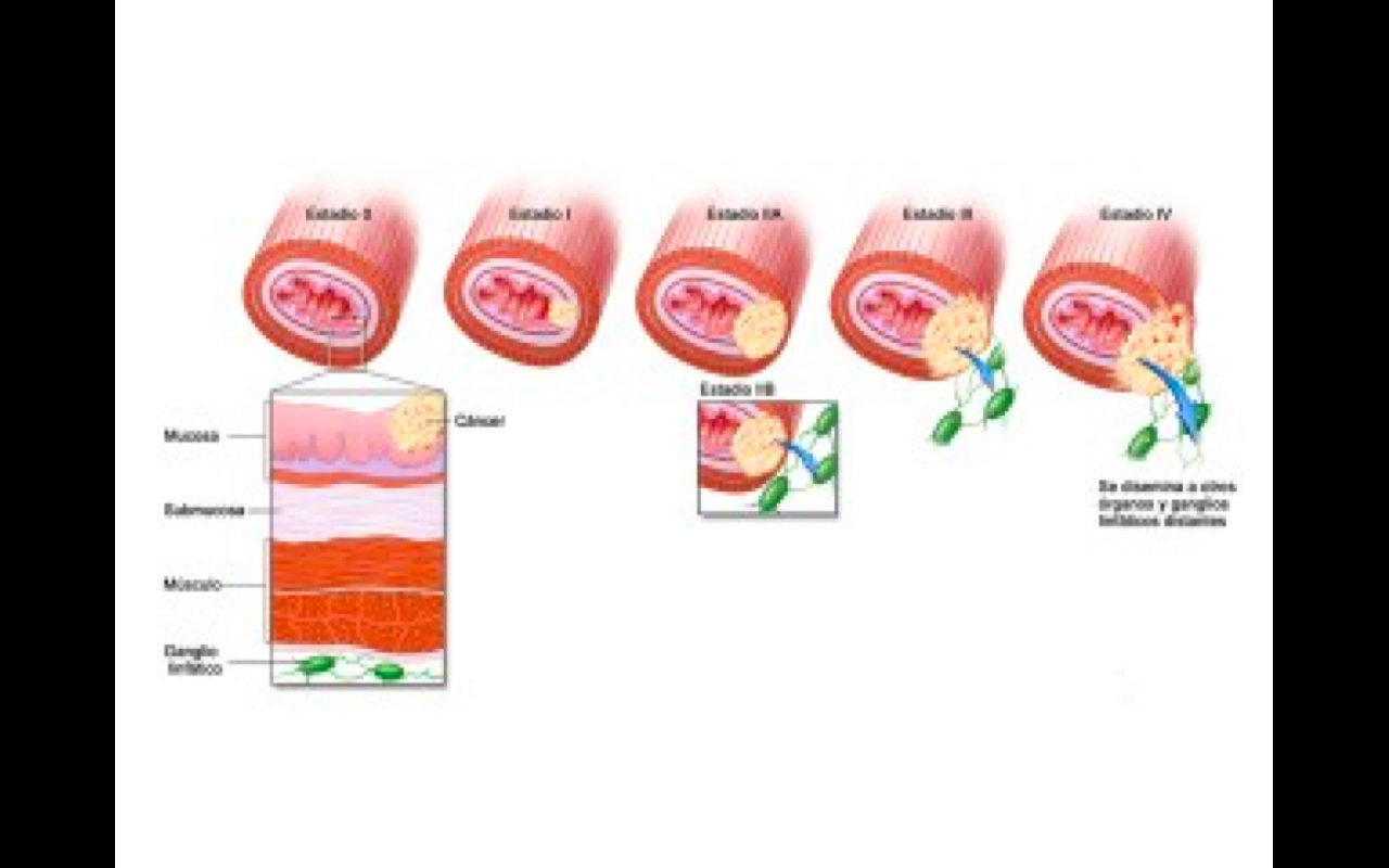 Patología de Esófago: ADENOCARCINOMA DEL TERCIO DISTAL DEL ESOFAGO ...